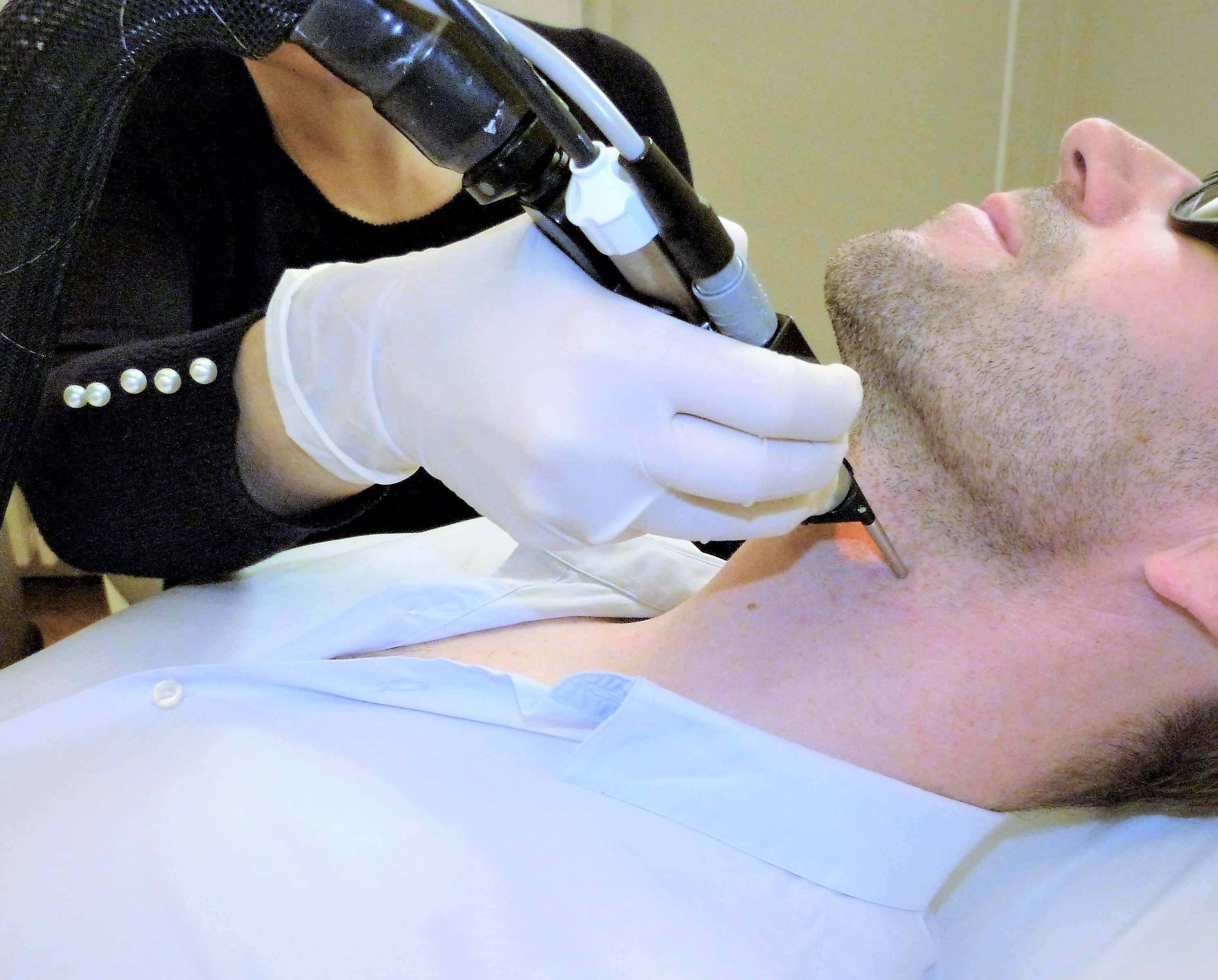 Épilation Laser de la barbe - Centre Laser Montpellier
