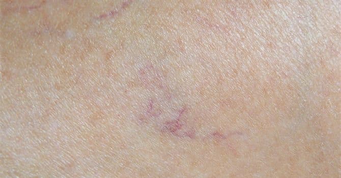 Traitement des Varicosités par laser avec le Centre Laser Montpellier